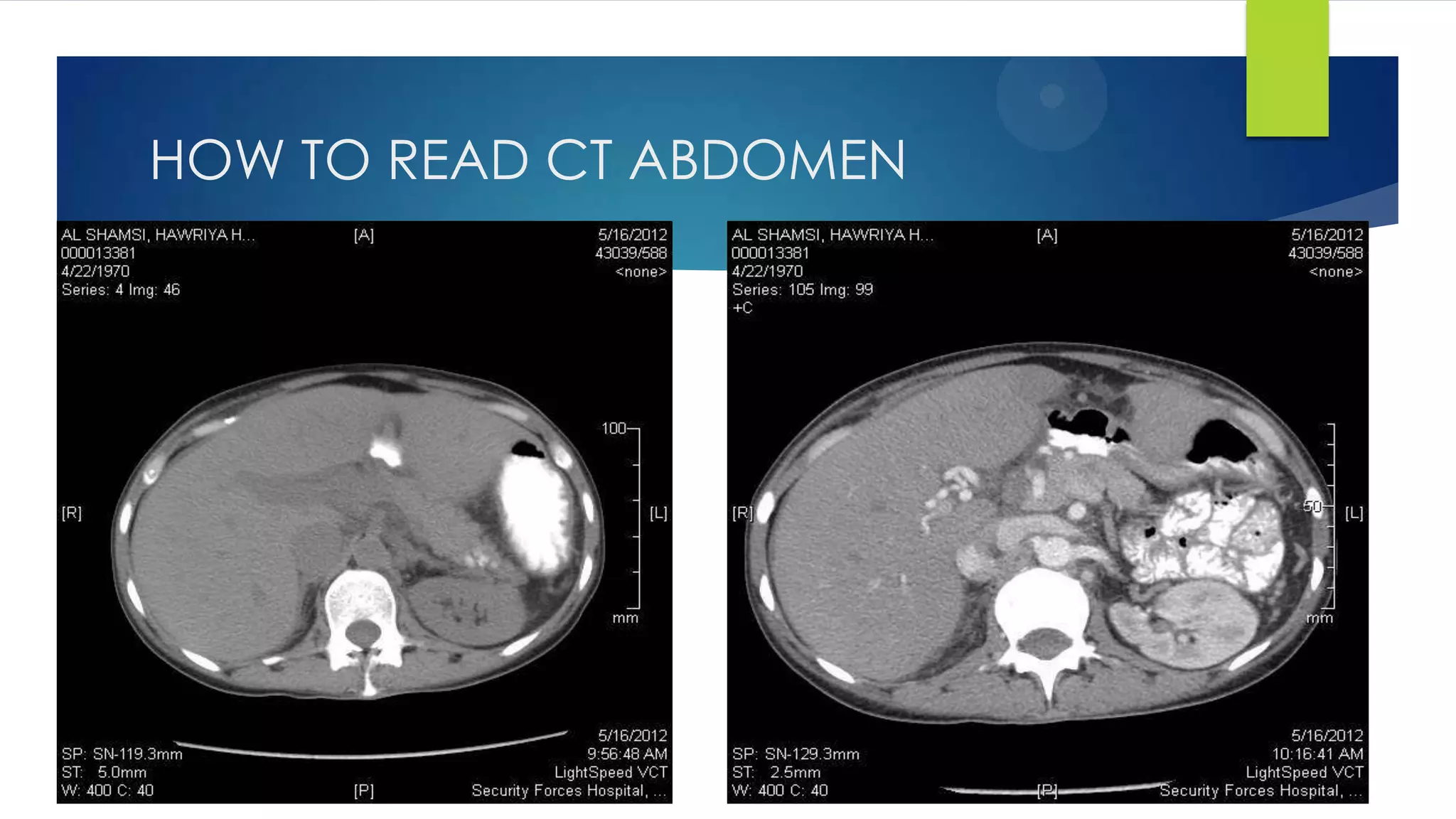 CT Abdomen Case based presentation | PPTX
