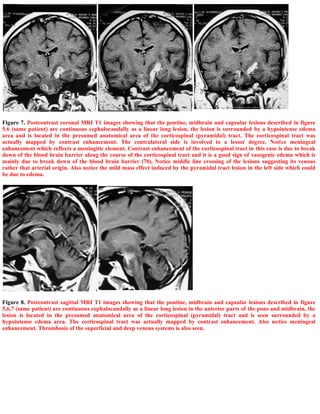 Case record...Neuro-Behcet | PDF