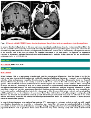 Case record...Neuro-Behcet | PDF
