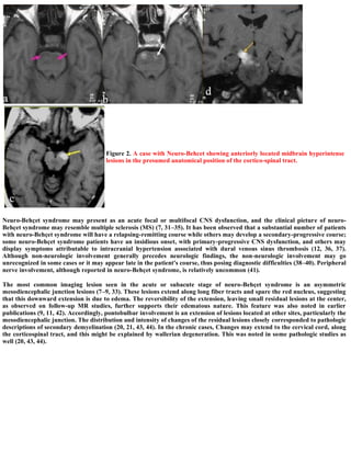 Case record...Neuro-Behcet | PDF