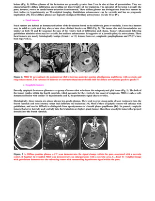 Case record...brain stem glioma | PDF