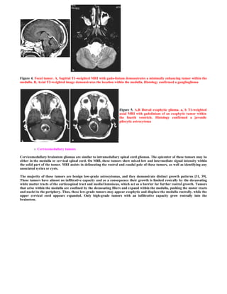 Case record...brain stem glioma | PDF