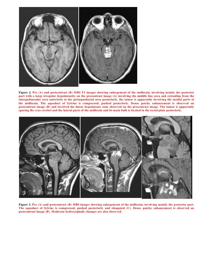 Case Recordfocal Midbrain Glioma