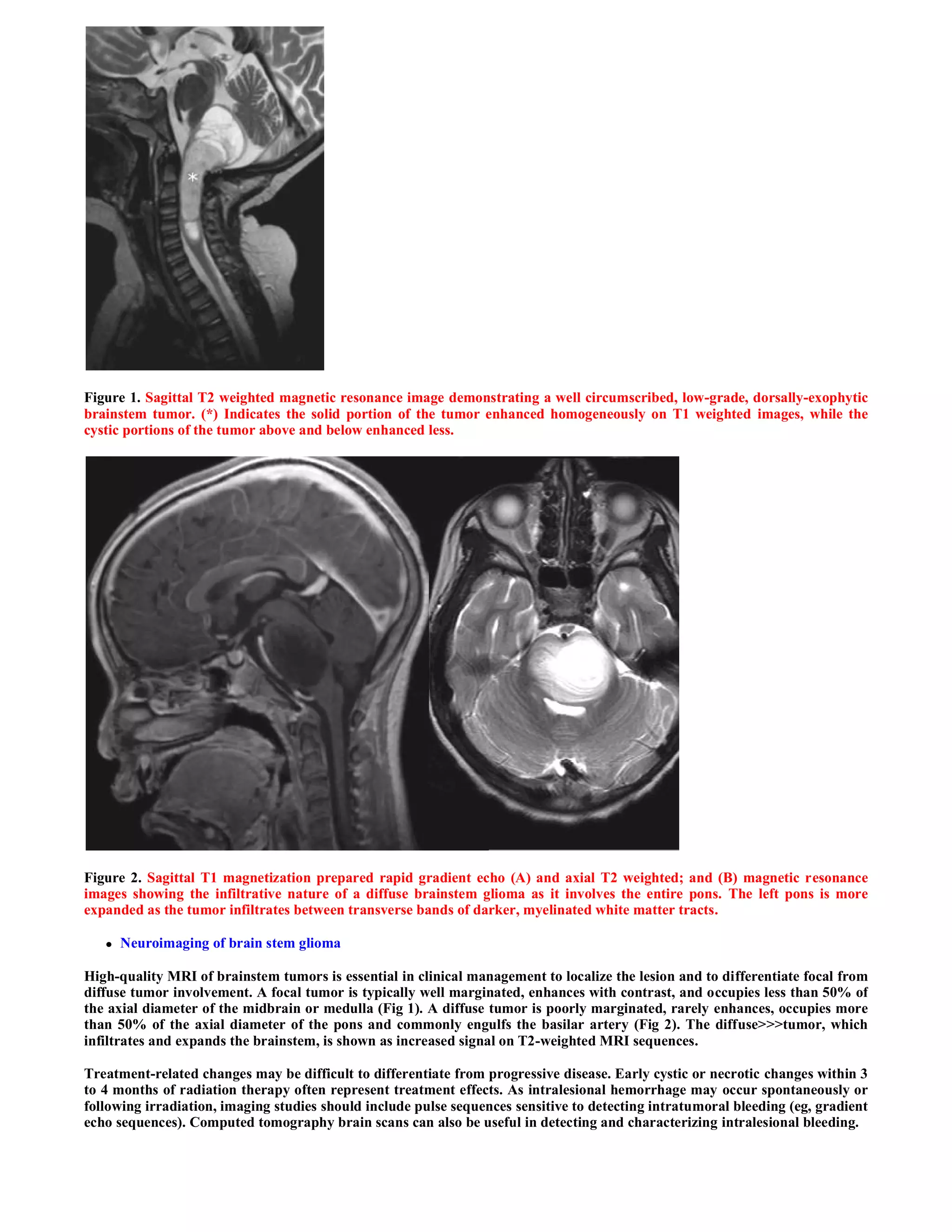 Case record...Tectal plate glioma | PDF