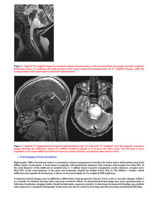 Case record...Tectal plate glioma | PDF