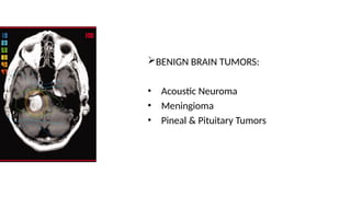 FSRT Fractionated Radiotherapy in Schwannoma | PPTX | Cancer | Diseases ...