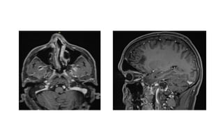 FSRT Fractionated Radiotherapy in Schwannoma | PPTX | Cancer | Diseases ...