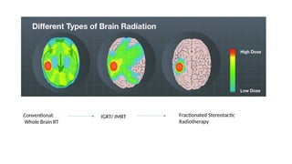 FSRT Fractionated Radiotherapy in Schwannoma | PPTX | Cancer | Diseases ...