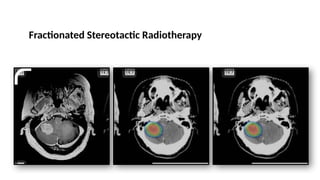 FSRT Fractionated Radiotherapy in Schwannoma | PPTX | Cancer | Diseases ...