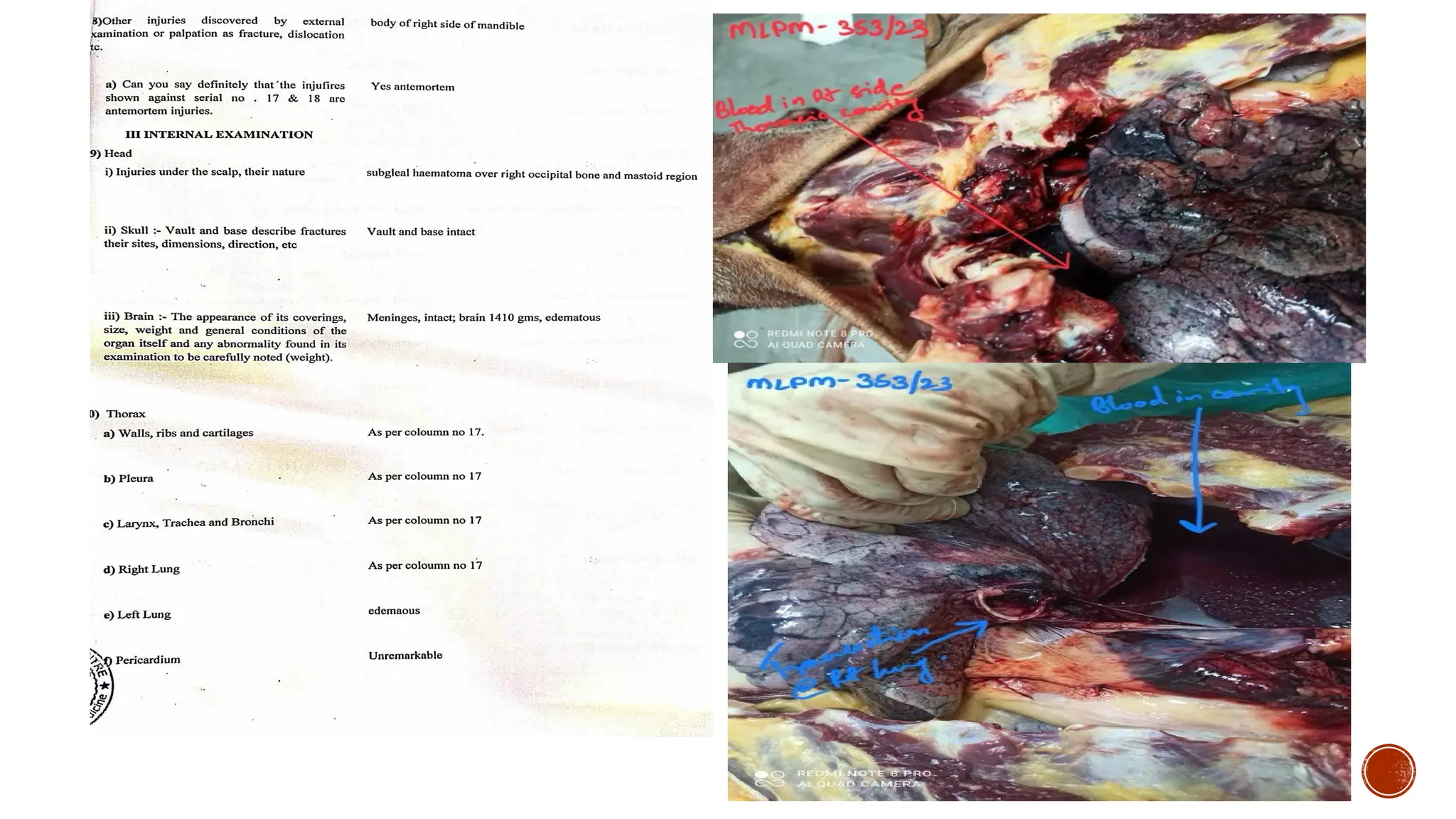 Case Chest Trauma forensic Medicine .pptx
