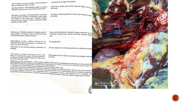 Case Chest Trauma forensic Medicine .pptx