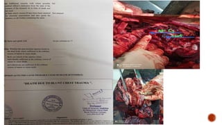 Case Chest Trauma forensic Medicine .pptx