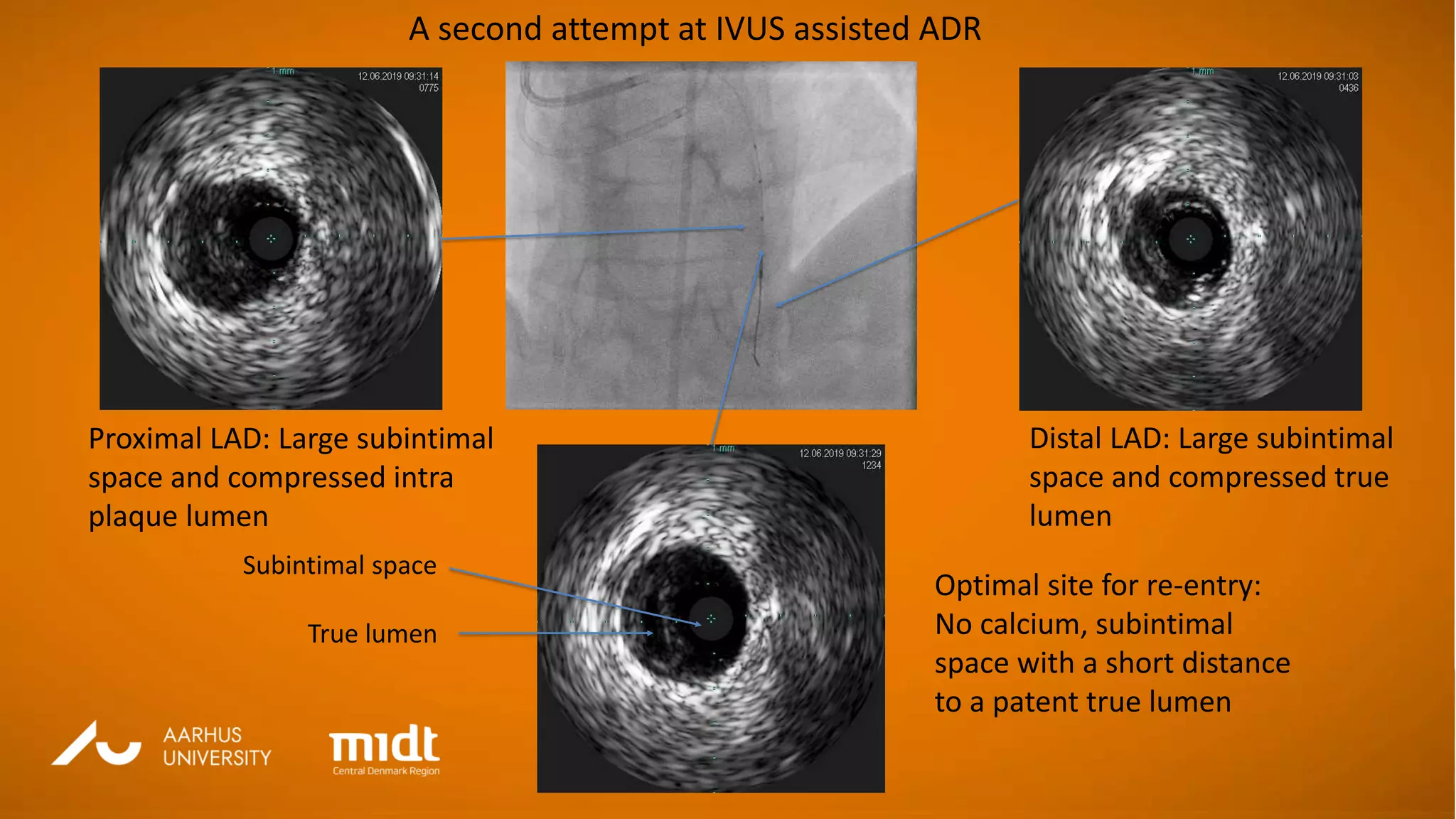IVUS assisted antegrade dissection and re entry (IAADR) | PPT