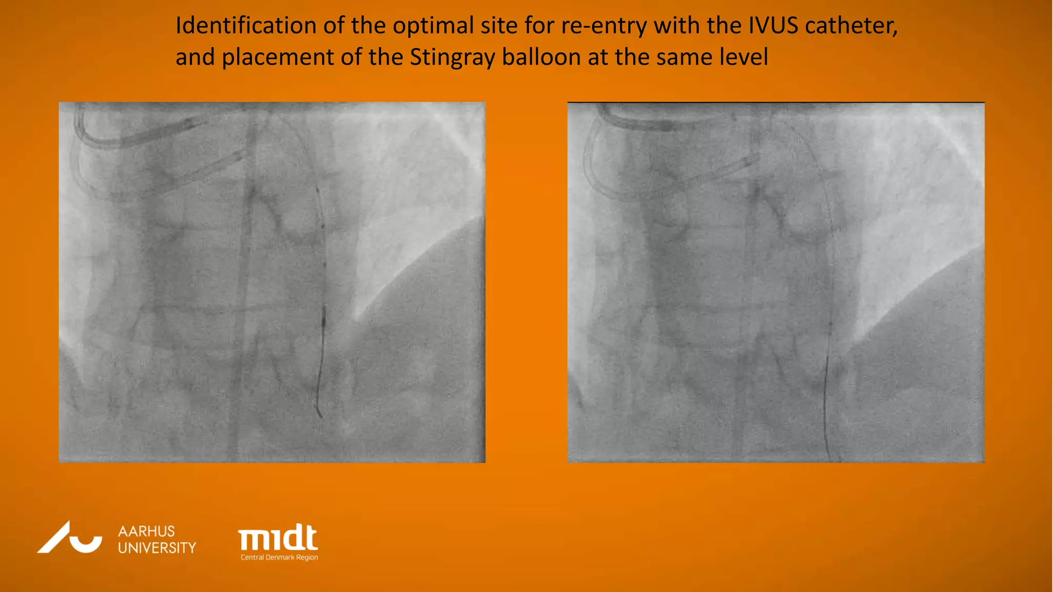 IVUS assisted antegrade dissection and re entry (IAADR) | PPT