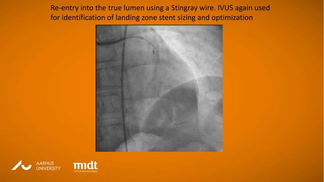 IVUS assisted antegrade dissection and re entry (IAADR) | PPT