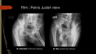 Hip dislocation | PPT