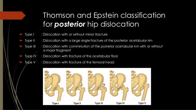 Hip dislocation