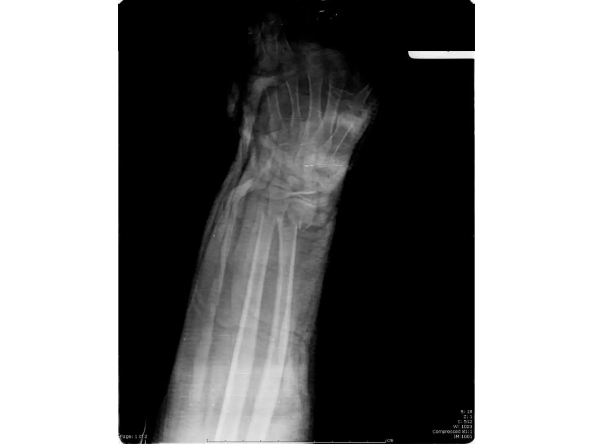 Case conference fracture both bone forearm in children | PPTX