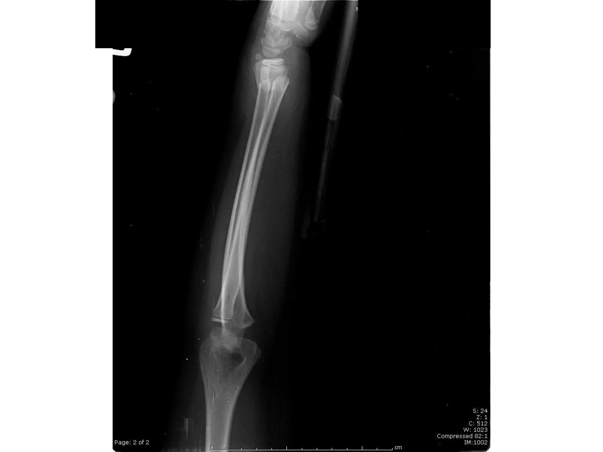 Case conference fracture both bone forearm in children | PPTX