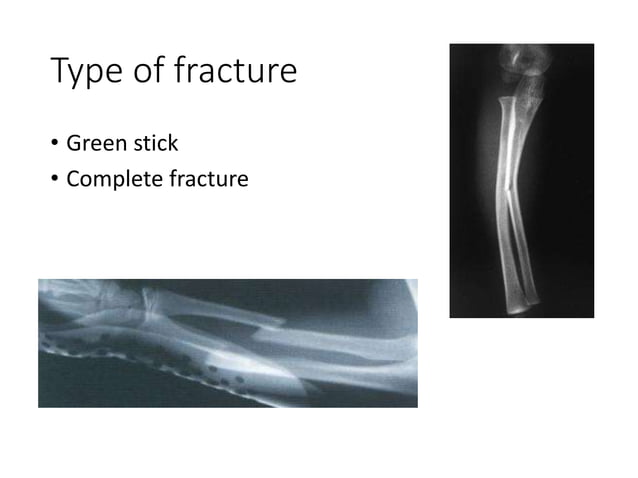 Case conference fracture both bone forearm in children | PPTX