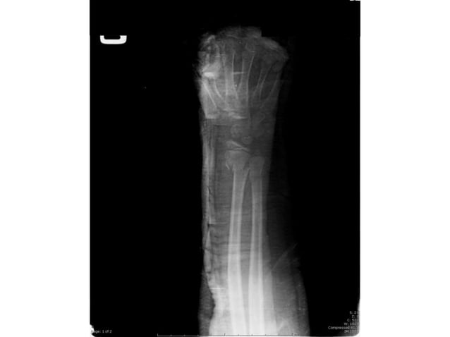 Case conference fracture both bone forearm in children | PPTX