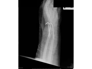 Case conference fracture both bone forearm in children | PPTX