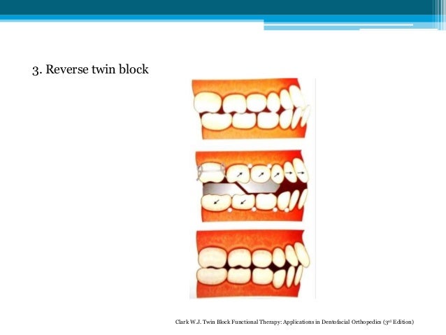 The Twin Block Appliance