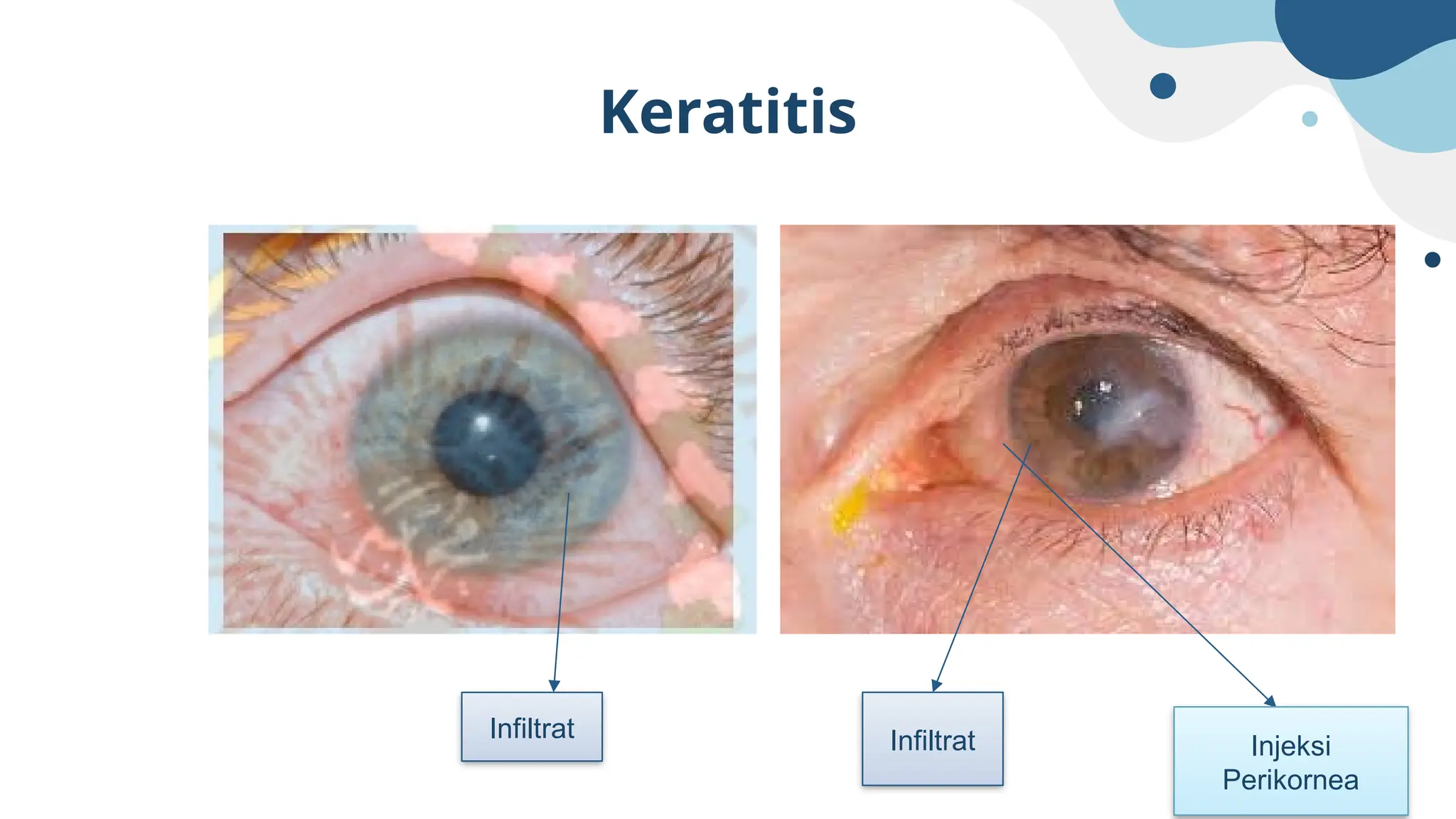 Cased Based Discussion Keratitis n .pptx