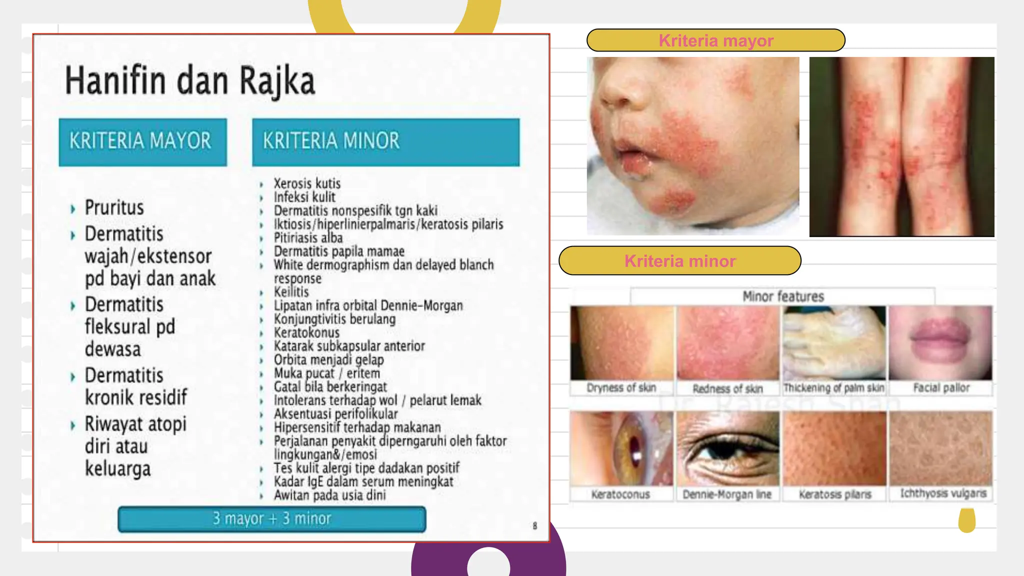 case report dermatitis atopik stase kulit kelamin | PPT