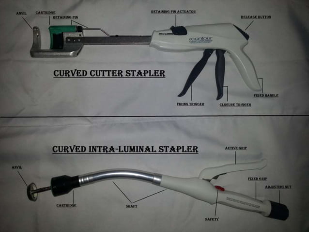 Adenocarcinoma Rectum and Low anterior resection using double stapling ...