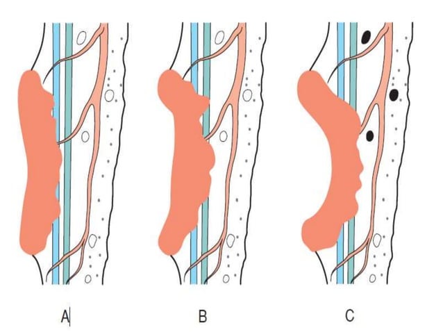 Adenocarcinoma Rectum and Low anterior resection using double stapling ...