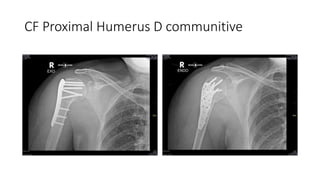 Case Discussion trauma orthopaedic .pptx
