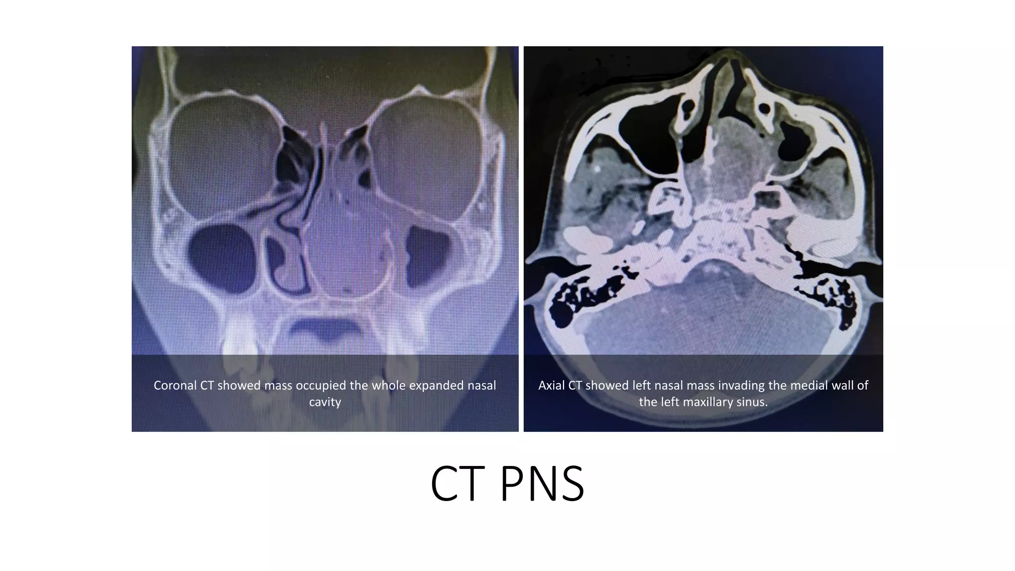 Juvenile nasopharyngeal angiofibroma (JNA) - Case discussion | PPT