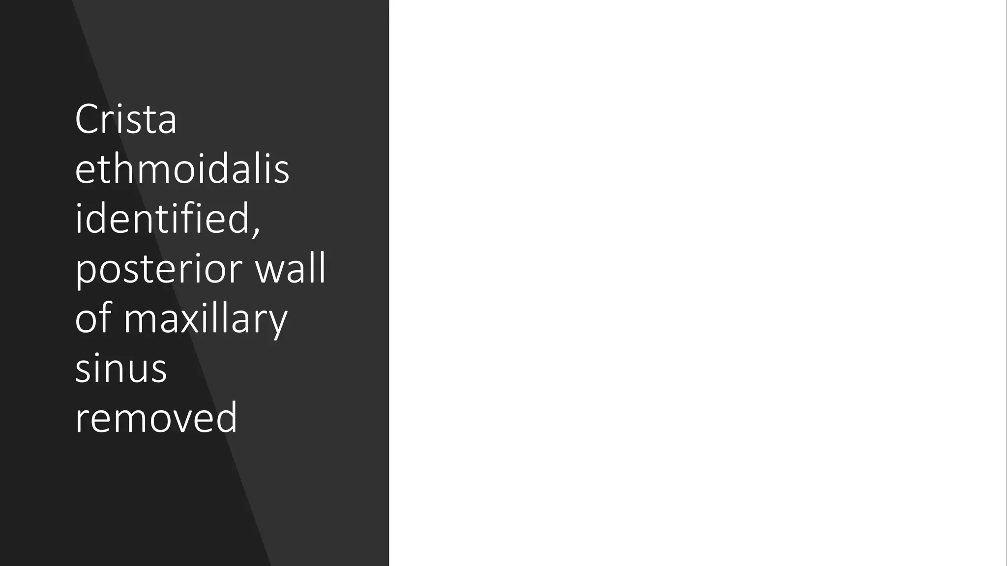 Juvenile nasopharyngeal angiofibroma (JNA) - Case discussion | PDF