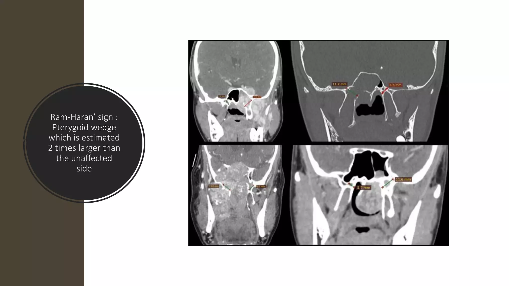 Juvenile nasopharyngeal angiofibroma (JNA) - Case discussion | PDF