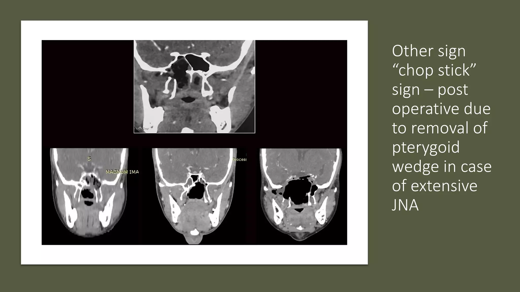 Juvenile nasopharyngeal angiofibroma (JNA) - Case discussion | PPT