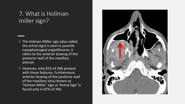 Juvenile nasopharyngeal angiofibroma (JNA) - Case discussion | PPT
