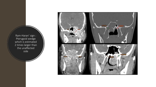 Juvenile nasopharyngeal angiofibroma (JNA) - Case discussion | PPT
