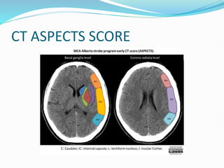 Case Discussion of Mechanical Thrombectomy[1].pptx