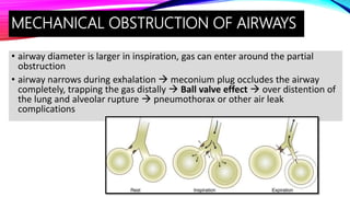 MECONIUM ASPIRATION SYNDROME, PERSISTENT PULMONARY HYPERTENSION | PPTX