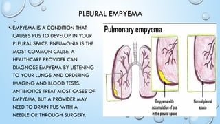 CASE DISCUSSION Pleural Emphyma & Lungs Abcess.pptx