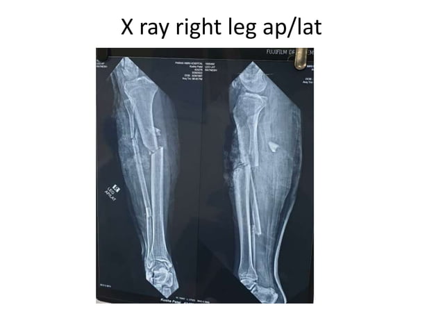 Open crushed Complex fracture dislocation of right lower limb with ...