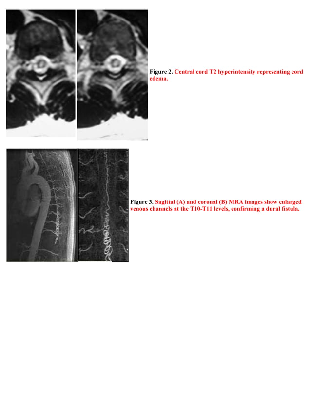 Case record...Spinal dural arteriovenous fistula with congestive ...