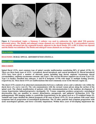 Case record...Spinal dural arteriovenous fistula with congestive ...