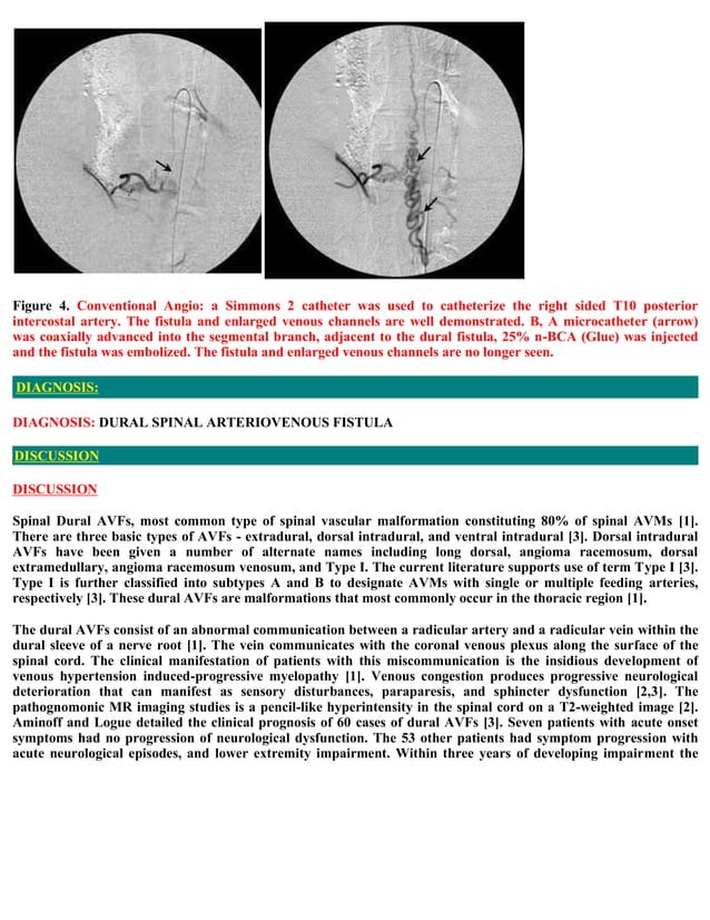 Case record...Spinal dural arteriovenous fistula with congestive ...