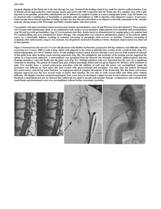 Case record...Spinal dural arteriovenous fistula | PDF