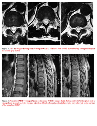 Case record...Spinal dural arteriovenous fistula with congestive ...
