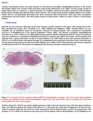 Case record...Spinal dural arteriovenous fistula with congestive ...