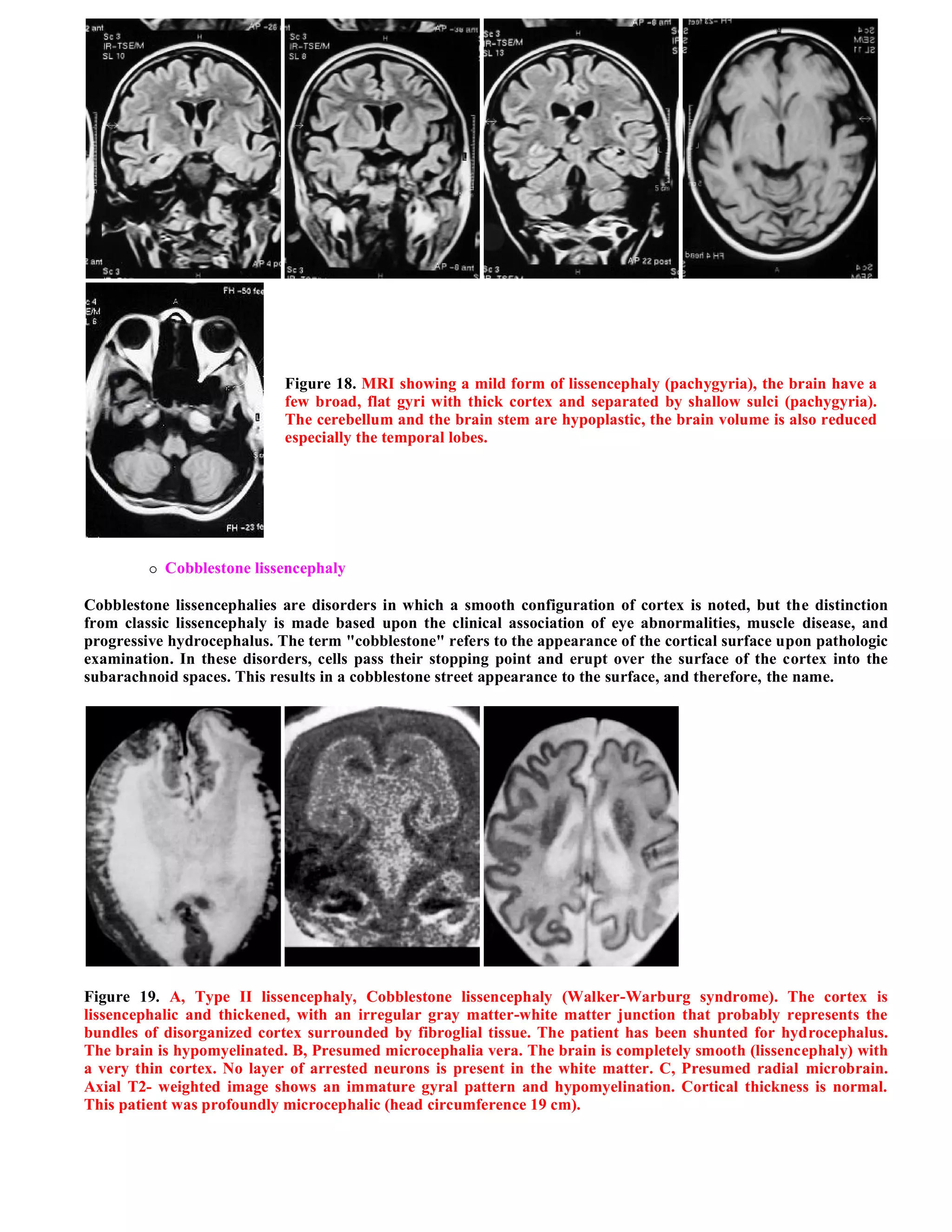 Case record...Cortical dysplasia | PDF