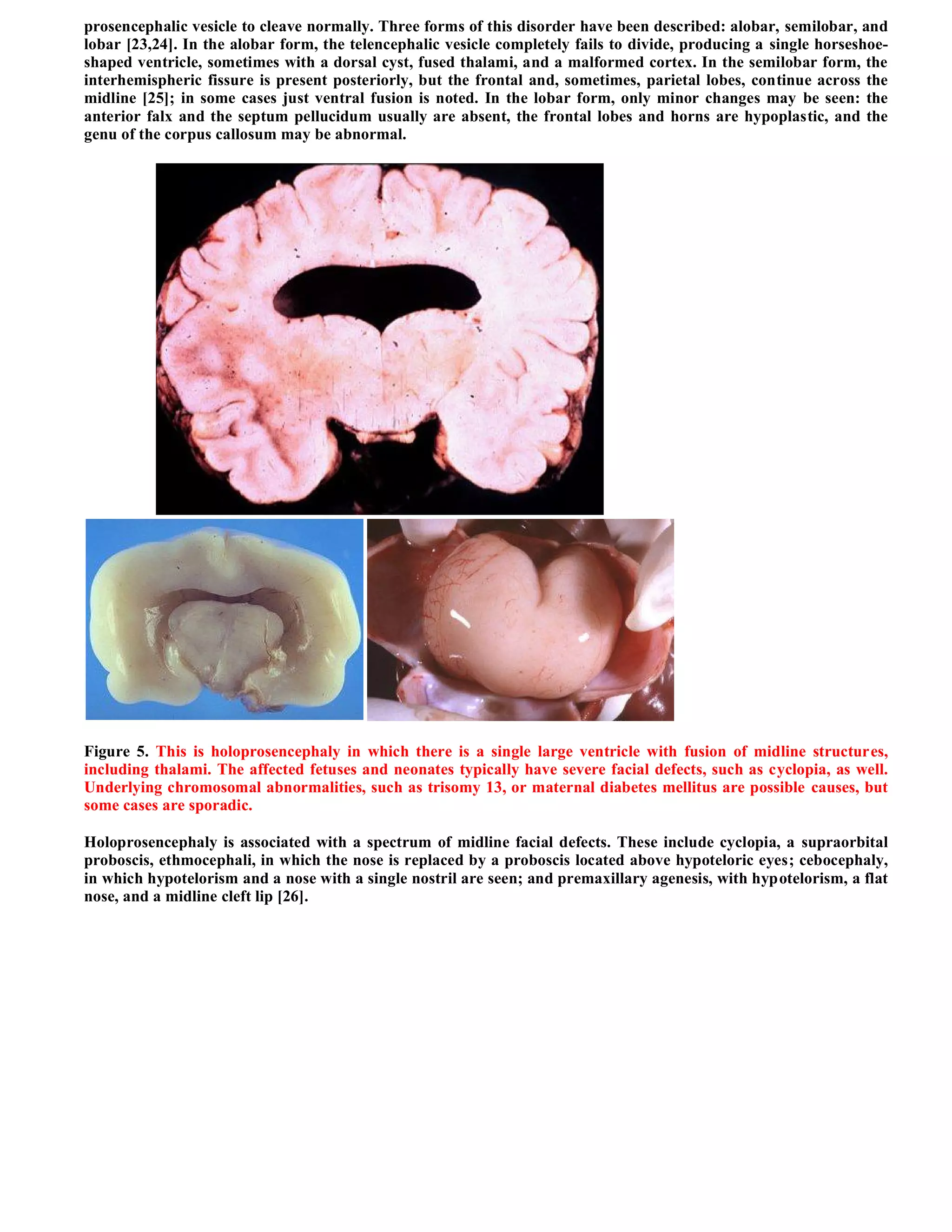 Case record...Cortical dysplasia | PDF